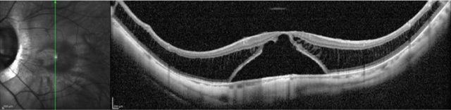 黄斑疾患｜近視から派生する目の疾患を知る - Myopia Square（マイオピア スクエア）
